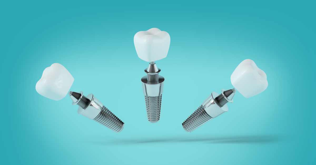 Understanding Dental Implants - Perfect Smiles: Discover Excellence at ...